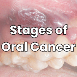 Understanding the Stages of Oral Cancer - Octavia Hospital